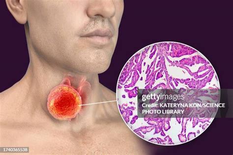 Thyroid Micrograph Photos And Premium High Res Pictures Getty Images