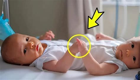 These Siamese Twins Were Separated 18 Years Ago And Everyone Was Convinced They Would Not