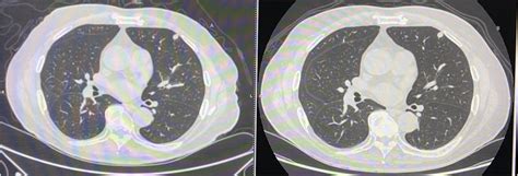 The Nonenhanced Pulmonary Nodule In The Anterior Segment Of The Left Download Scientific