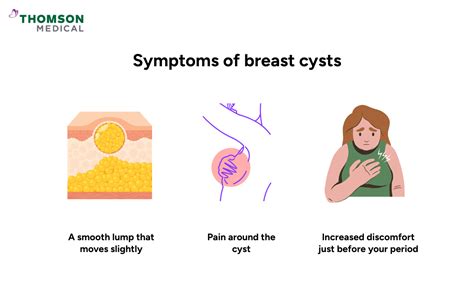 Breast Cyst Symptoms Causes And Treatment Options Thomson Medical