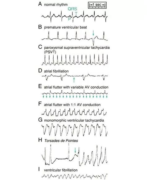 Normal Sinus Rhythm Artofit