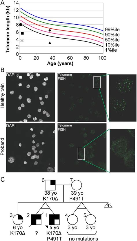 Hoyeraal Hreidarsson Syndrome Caused By A Germline Mutation In The Tel