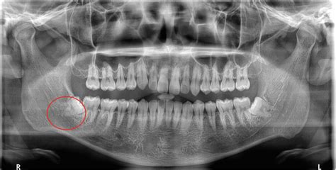 【症例】骨に埋まっている親知らずを抜歯｜渋谷の歯医者｜渋谷マロン歯科tokyo