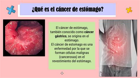 Tipos De Cáncer De Estómago