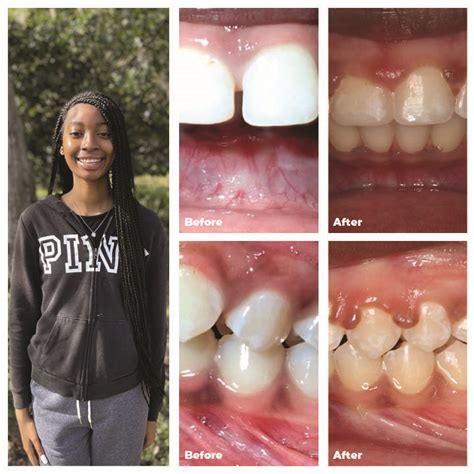 Get Clear Braces That Match The Color Of Your Teeth
