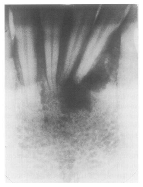 Perlapical Radiograph Showing The Periradicular Rodiolucent Area With