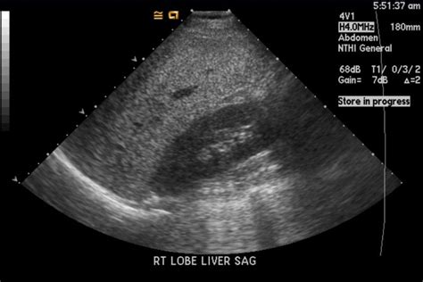 Liver Disease Ultrasound Images At Amber Royalty Blog