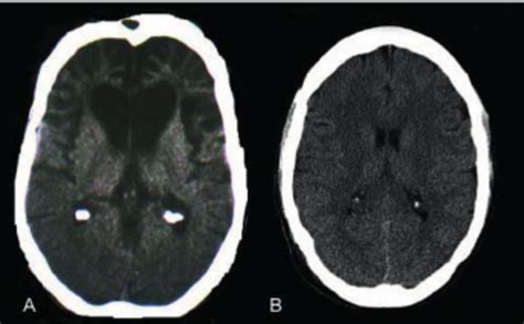 Mr As Computed Tomography Ct Scan Showing Severe Bifrontal And