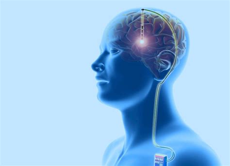 Medtronic Earns Us Fda Approval For Worlds First Adaptive Deep Brain