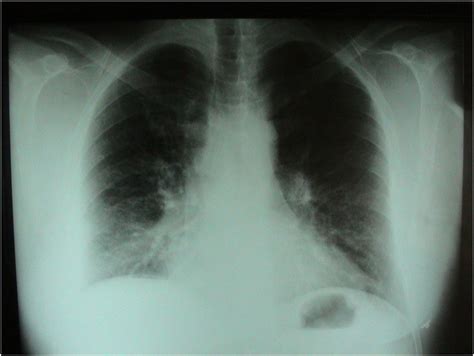 Chest X Ray Ap Right Lung Base Infiltrates Download Scientific