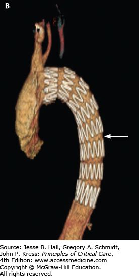 Aortic Dissection Anesthesia Key