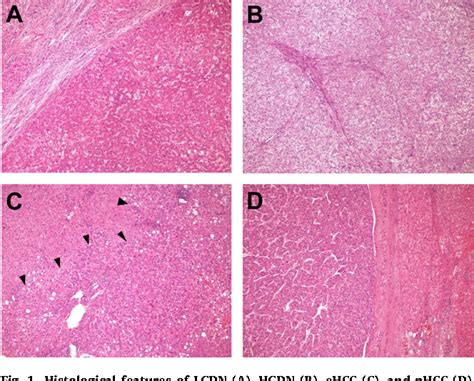 High Grade Liver Dysplastic Nodule Semantic Scholar