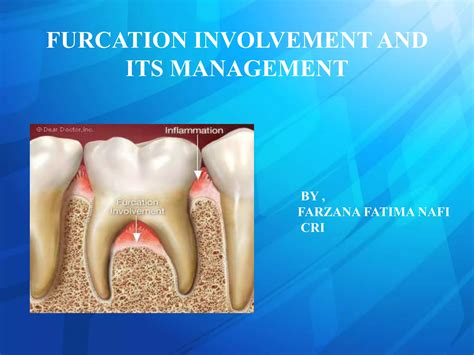 Furcation Involvement And Its Management Ppt