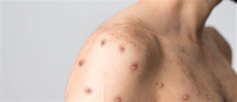 Primeiro Caso De Varíola Do Macaco é Confirmado No Brasil Pedra Azul News