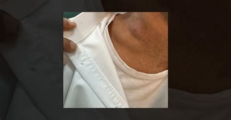 Management Of Tuberculosis Lymphadenitis In A Young Adult Medsynapse