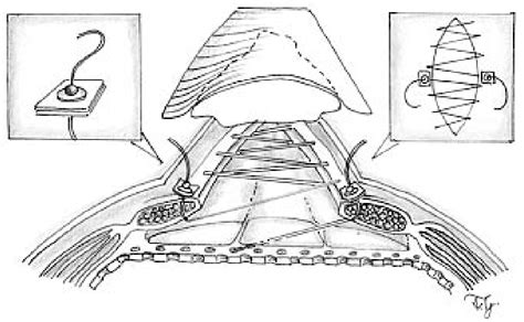 Figure 1 From Continuous Retention Suture For The Management Of Open