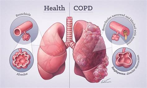 What Are The Risk Factors For Developing Copd Fitpaa