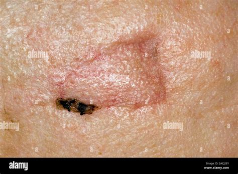 Close Up Of A Scar On The Skin In A 75 Year Old Male Patient 1 Month