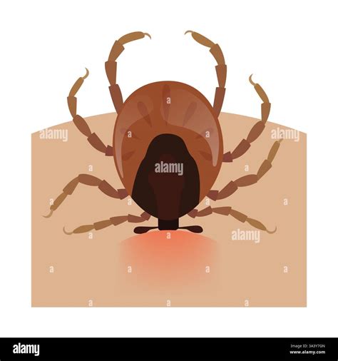 Encephalitis Tick Biting Human Skin Causing Lyme Disease Stock Vector