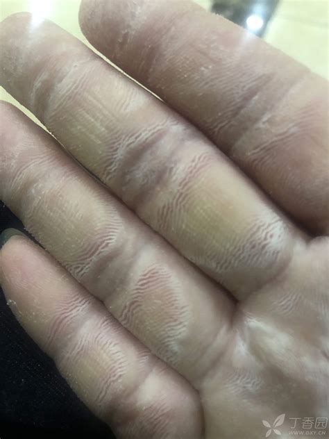 求救，求救，行性对称性红斑角皮症还是掌跖角化症 丁香园论坛