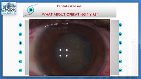 Nanophthalmus Retinal Detachment Scleral Window Surgery Youtube