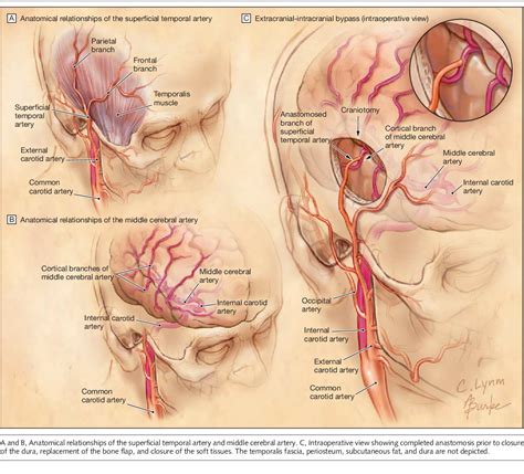Figure 1 From Extracranial Intracranial Bypass Surgery For Stroke Prevention In Hemodynamic