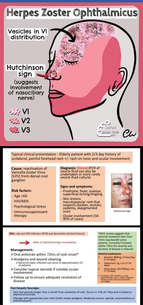 Nasociliary Nerve Shingles Shingles A Complete Guide For Clinicians