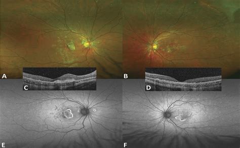 Multi Modal Imaging In Diffuse Subretinal Fibrosis With Uvei