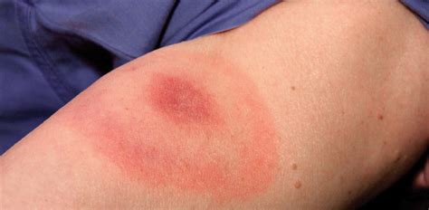 Borelioza Objawy Diagnostyka Leczenie Wojskowy Instytut Medyczny