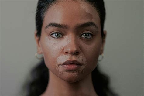 Dermatology Spinoff Dermavon Files For Ipo With Vitiligo Drug As