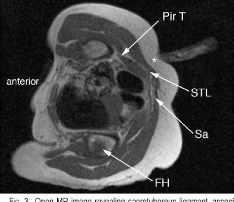 Figure 5 From Diagnosis And Treatment Of Pudendal Nerve Entrapment