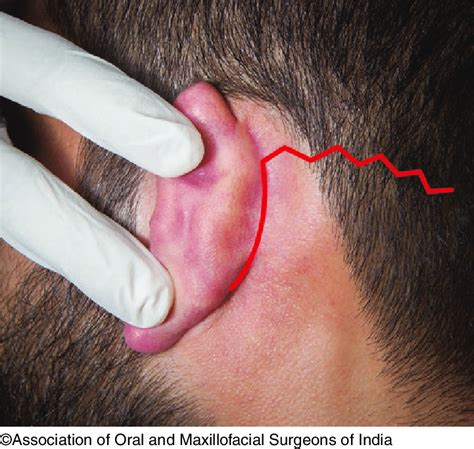 12 Illustration Showing The Postauricular And Occipital Or Scalp