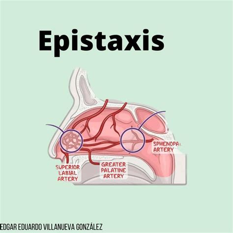 Epistaxis Drvillanueva Udocz