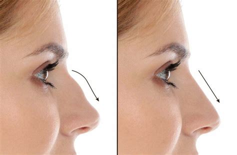 Perfect Nose Job