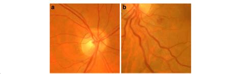 Tortuous Veins Eyes Clipart