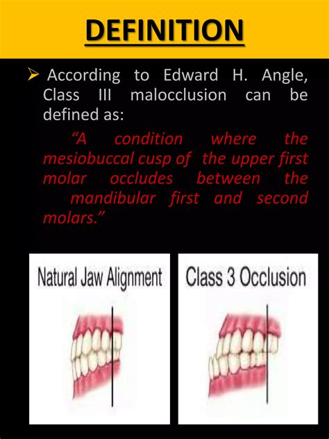 Class Iii Malocclusion Pptx