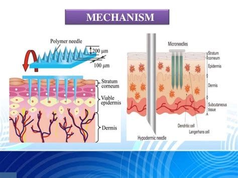 Microneedle Technology