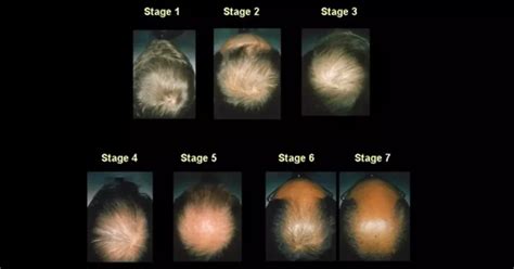 Male Pattern Baldness Everything You Need To Know