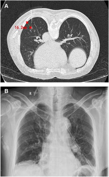 Thoracoscopic Anatomic Left Lower Lobe S6b Subsegmentectomy The Annals Of Thoracic Surgery