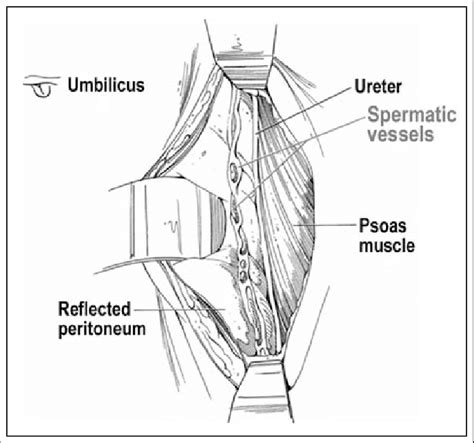 Varicocelectomy Procedure