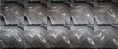 CT Of Shoulder Coronal View Figure 2 CT Of Shoulder Download Scientific Diagram