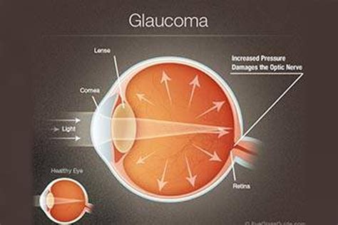 Glaucoma Eye