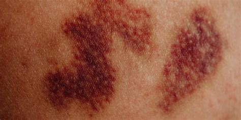 ¿qué Es Un Hematoma Y Qué Tipos Hay Blog Saludonnet