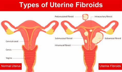 Understanding Uterine Fibroids Causes Symptoms And Treatment
