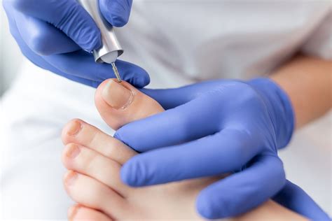 Nail Pterygium Release Doral Health And Wellness Ny