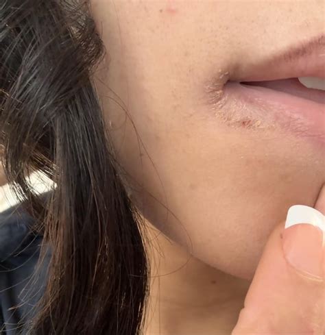 Angular Cellulitis Rmedicaladvice