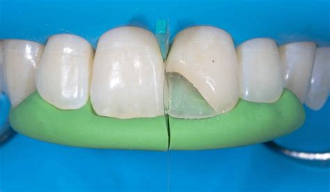 Highly Aesthetic Class Iv Composite Restoration