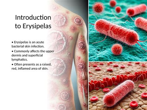 Erysipelas Etiology And Epidemiology Presentation Pptx