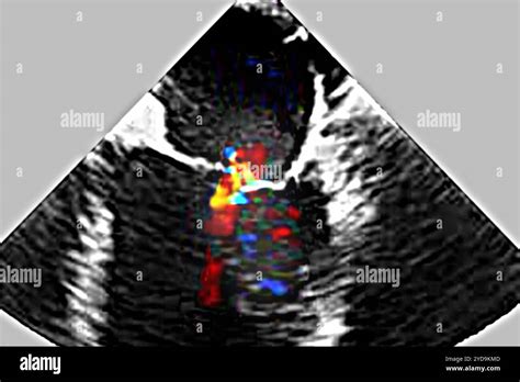 Ischemic Mitral Insufficiency Mi Pathology Of The Left Ventricle