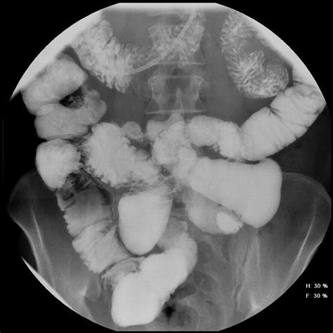 Enteroclysis Usa News Collections